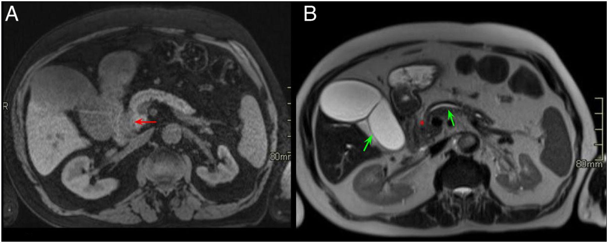 Groove pancreatitis and how to differentiate it from pancreatic ...