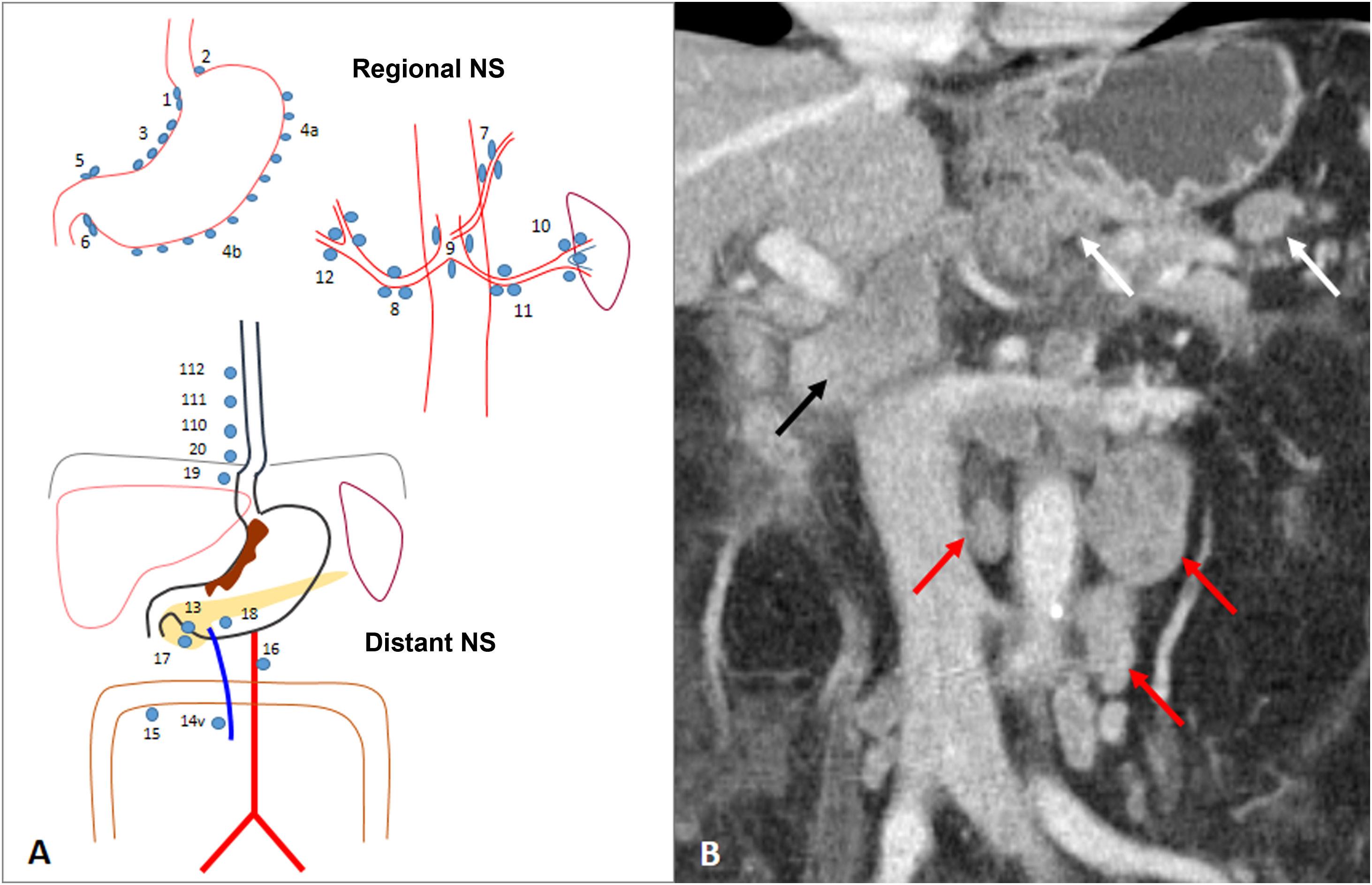 Gastric adenocarcinoma: A review of the TNM classification system and ways of spreading ...