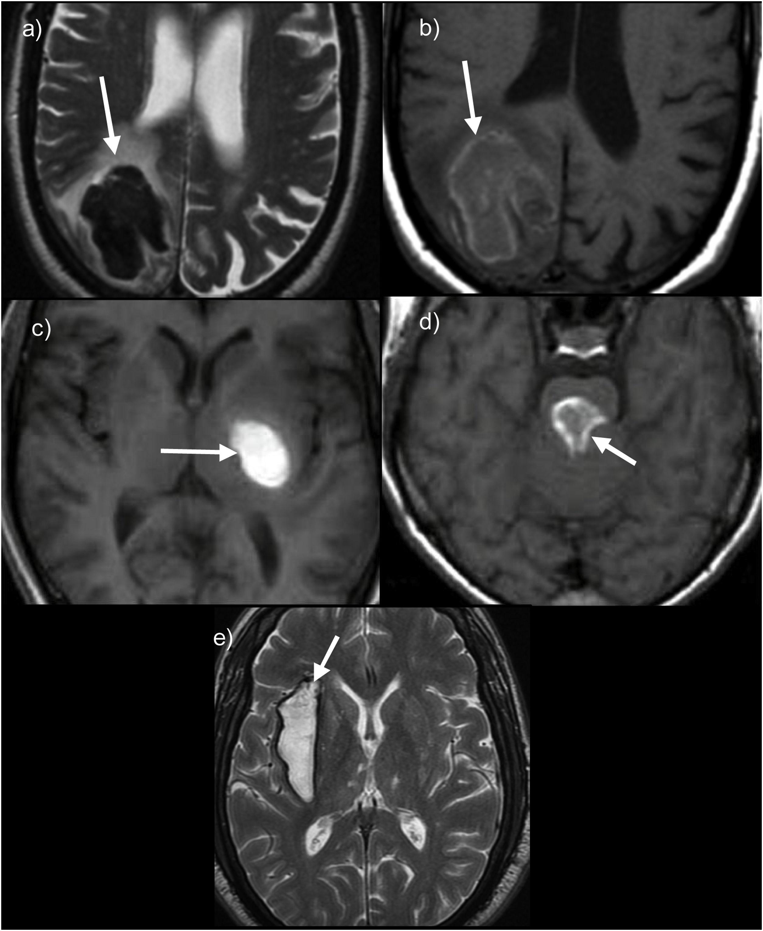 Primary and secondary non-traumatic intra-cerebral haemorrhage: MRI ...
