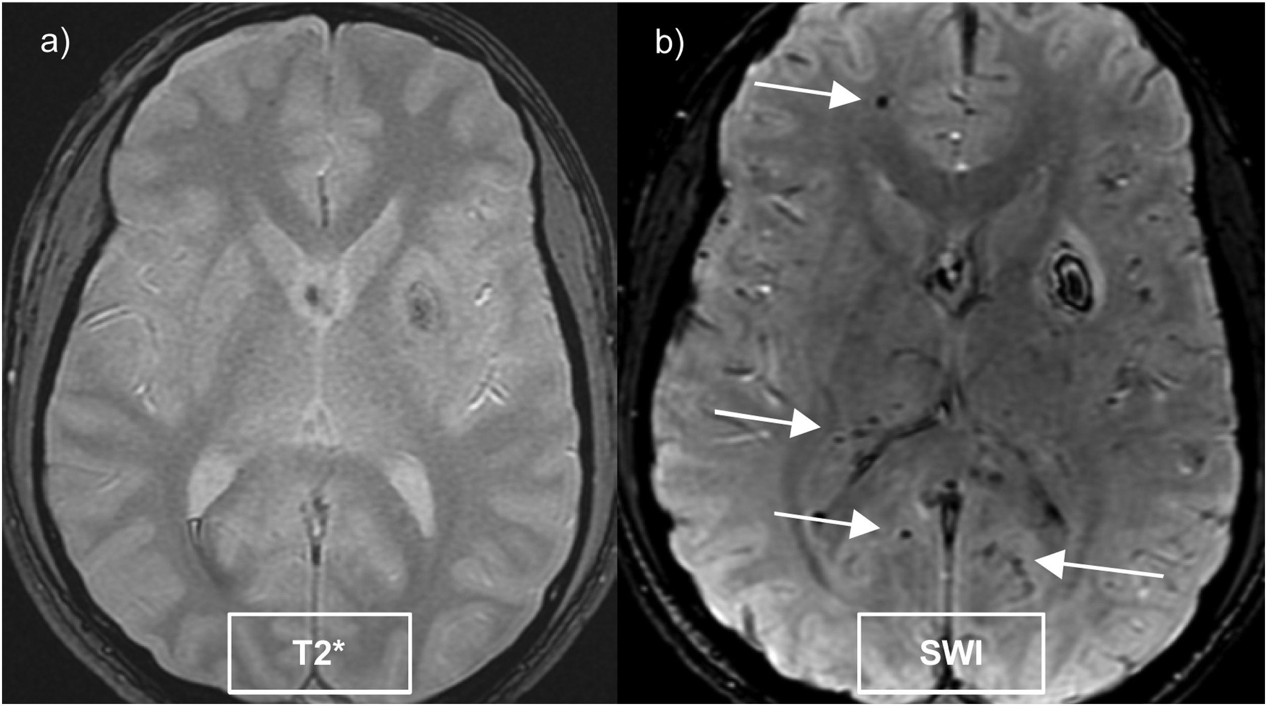 Primary and secondary non-traumatic intra-cerebral haemorrhage: MRI findings | Radiología ...