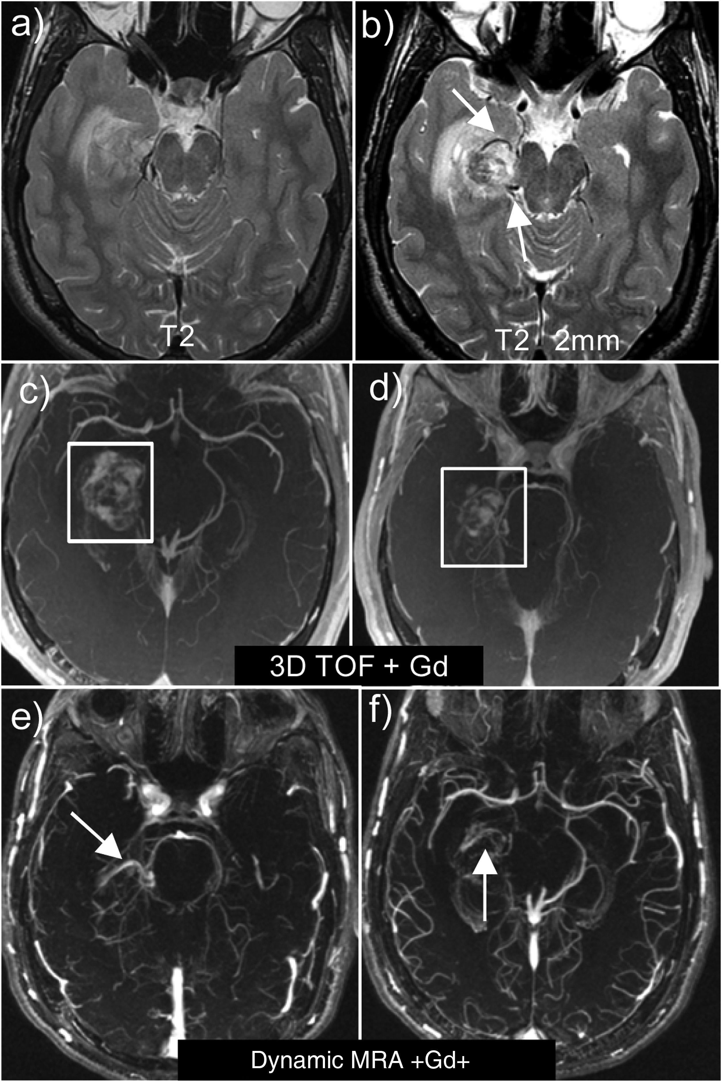 Primary and secondary non-traumatic intra-cerebral haemorrhage: MRI ...
