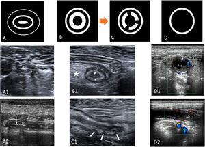 Update on acute appendicitis: Typical and untypical findings ...