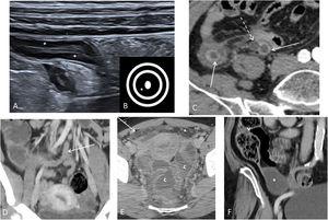 Update on acute appendicitis: Typical and untypical findings ...