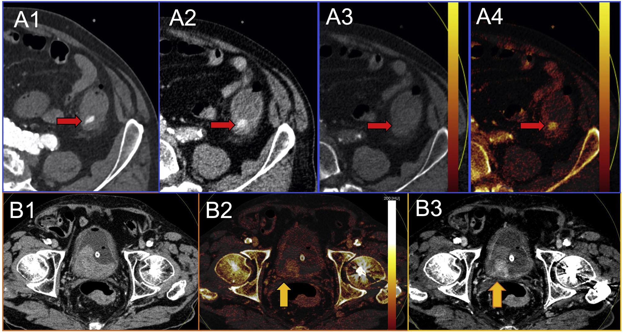 Spectral CT in Emergency | Radiología (English Edition)
