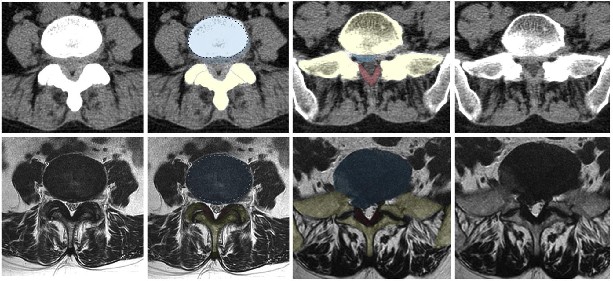 Diagnostic accuracy of lumbar CT and MRI in the evaluation of chronic ...
