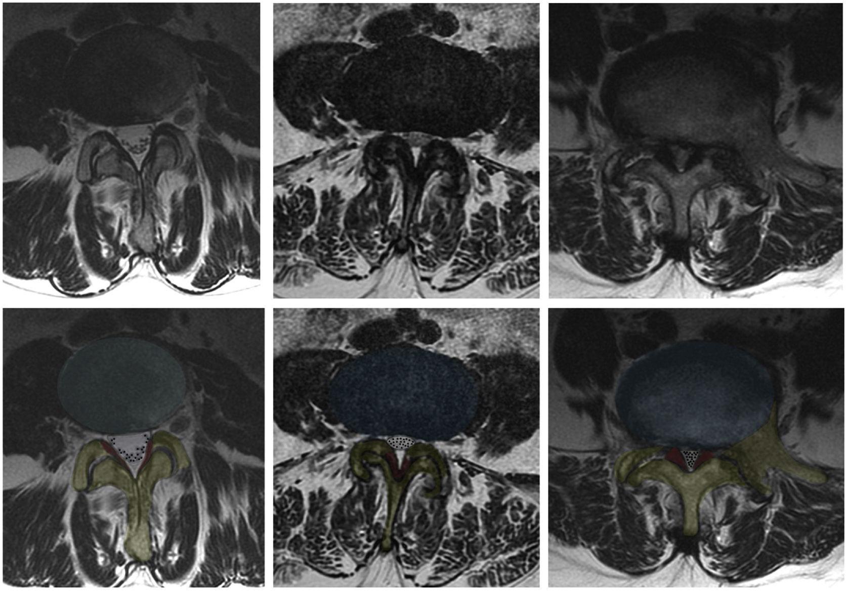 Diagnostic accuracy of lumbar CT and MRI in the evaluation of chronic ...