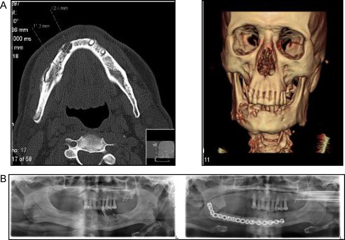Bisphosphonate-associated osteonecrosis of the jaws in lung cancer ...