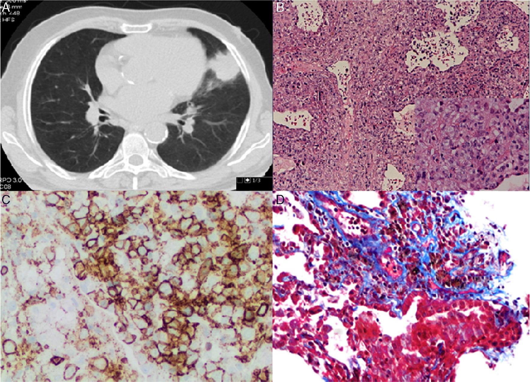 Lymphomatoid granulomatosis – A rare pulmonary lymphoproliferative ...