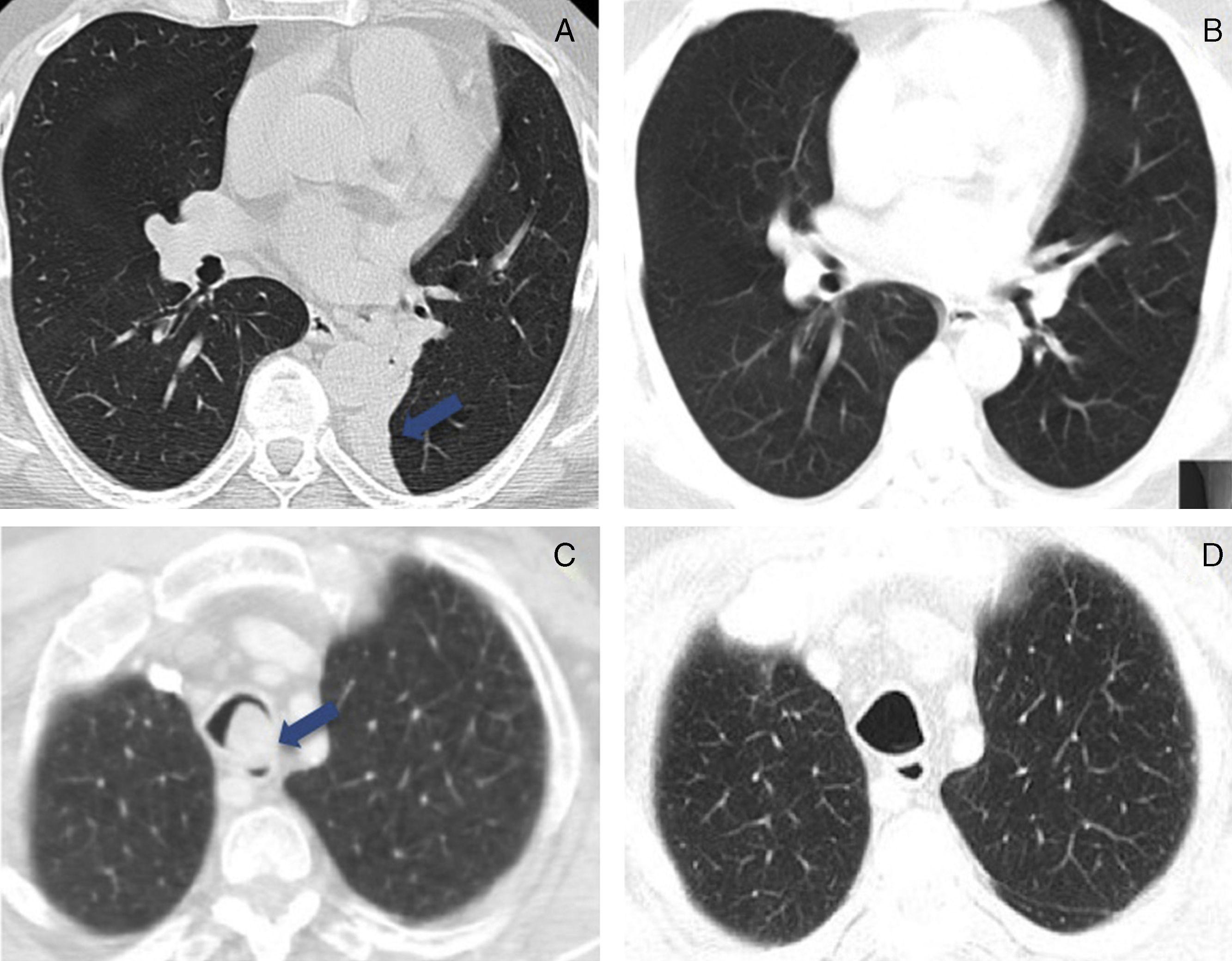 How to treat a glomus tumor of the airways? | Pulmonology