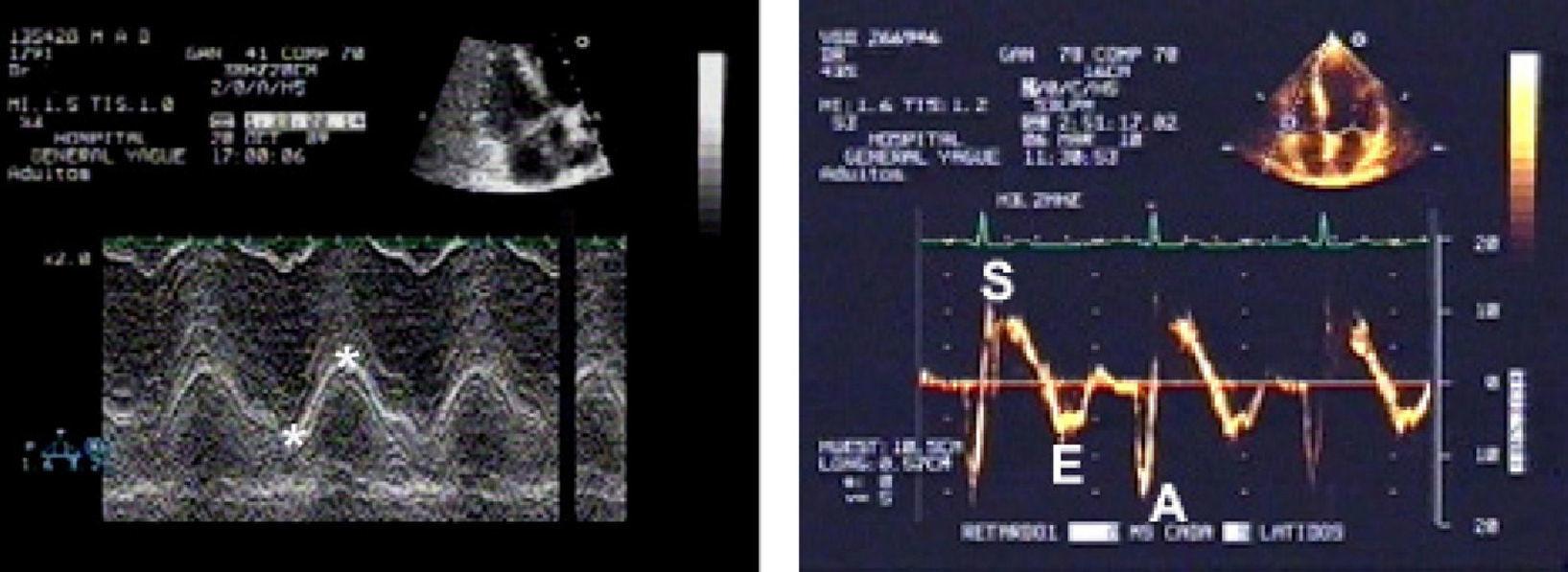 Role of echocardiography in the hemodynamic monitorization of critical ...