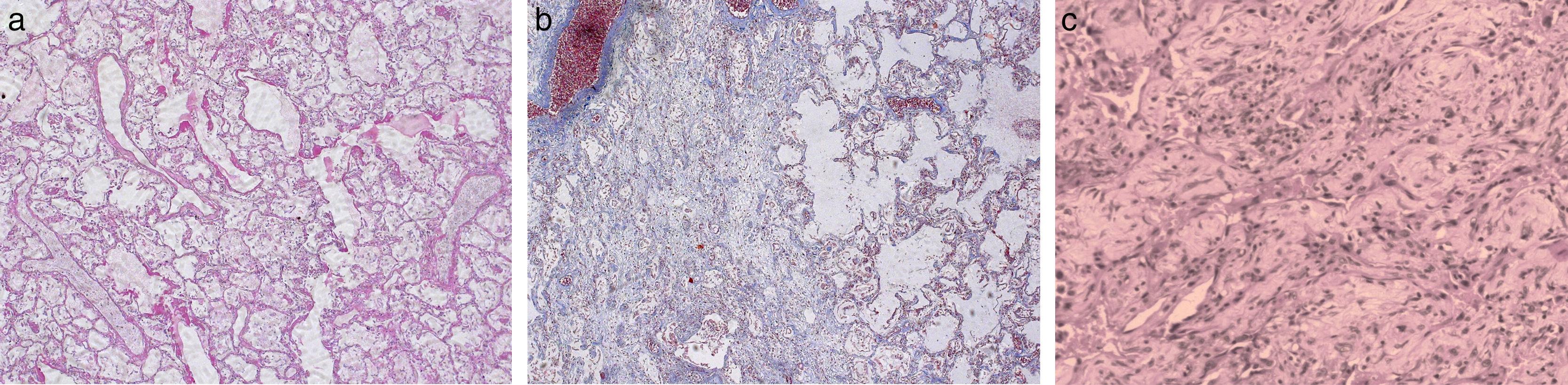 Acute Respiratory Distress: From syndrome to disease | Medicina Intensiva