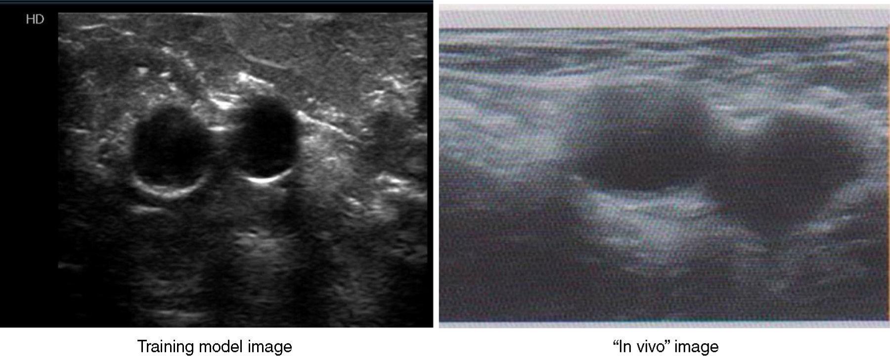 Design and application of model for training ultrasound-guided vascular ...