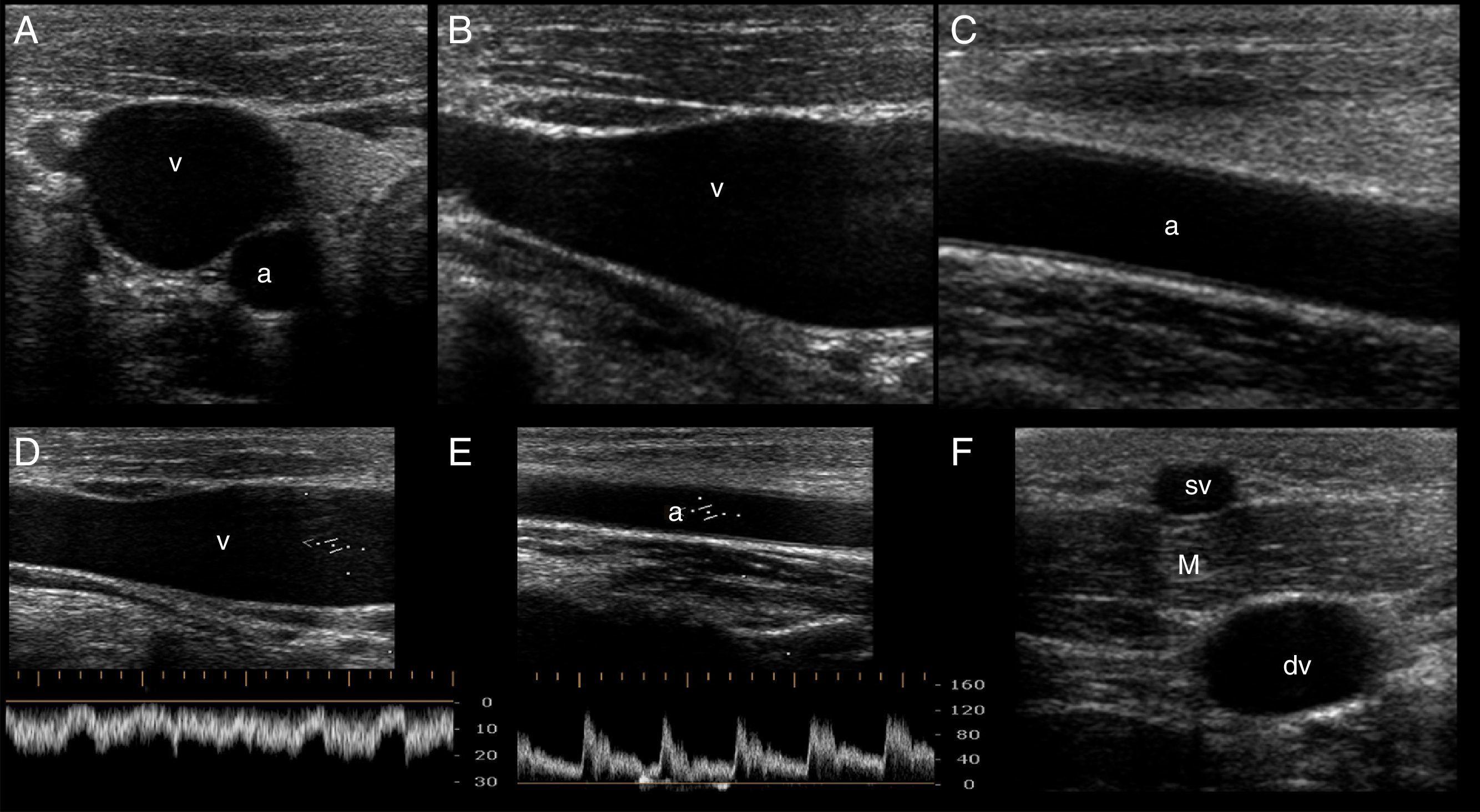 Deep Femoral Artery Ultrasound