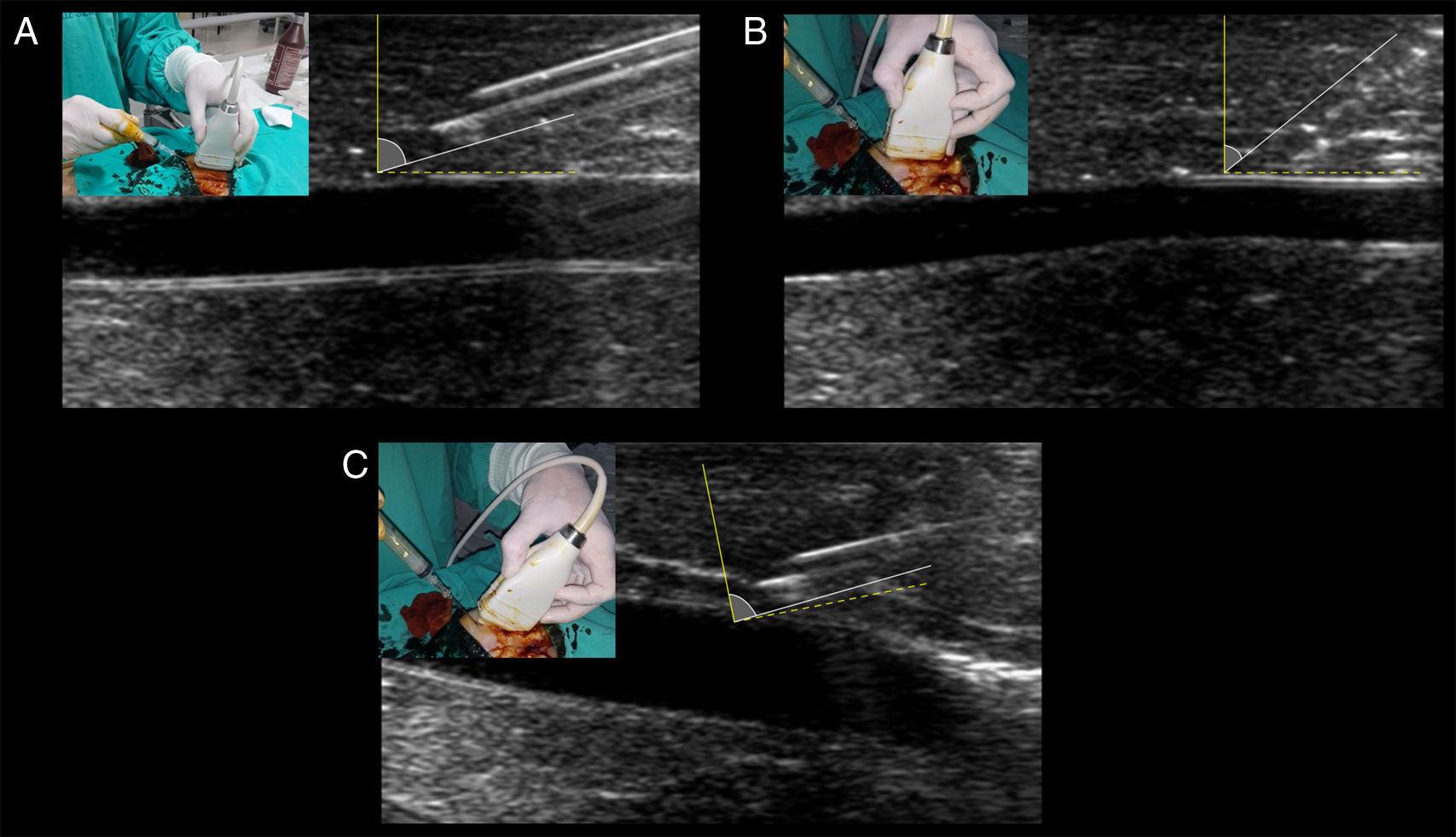Ultrasound-guided vascular cannulation in critical care patients: A ...