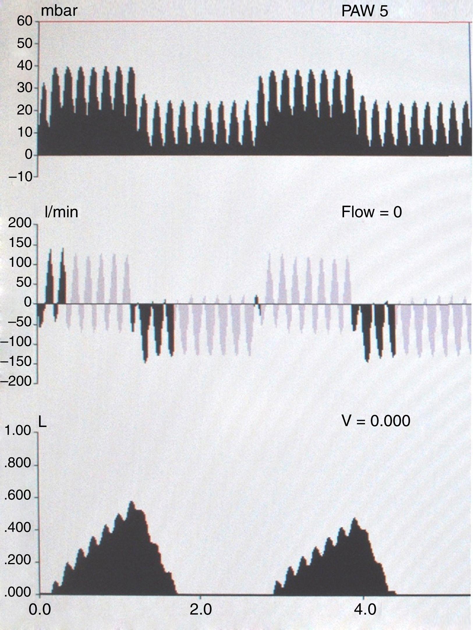 Ineffective cough and mechanical mucociliary clearance techniques ...