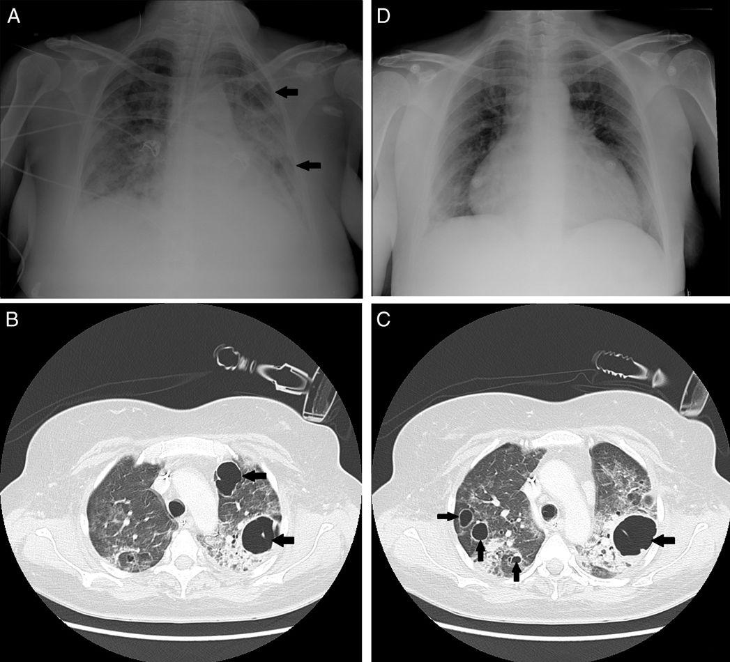 Pneumoceles in out-hospital methicillin-sensitive Staphylococcus aureus ...