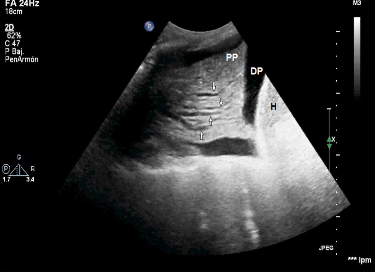Basic sign in lung echography. Liquid and air bronchogram ...