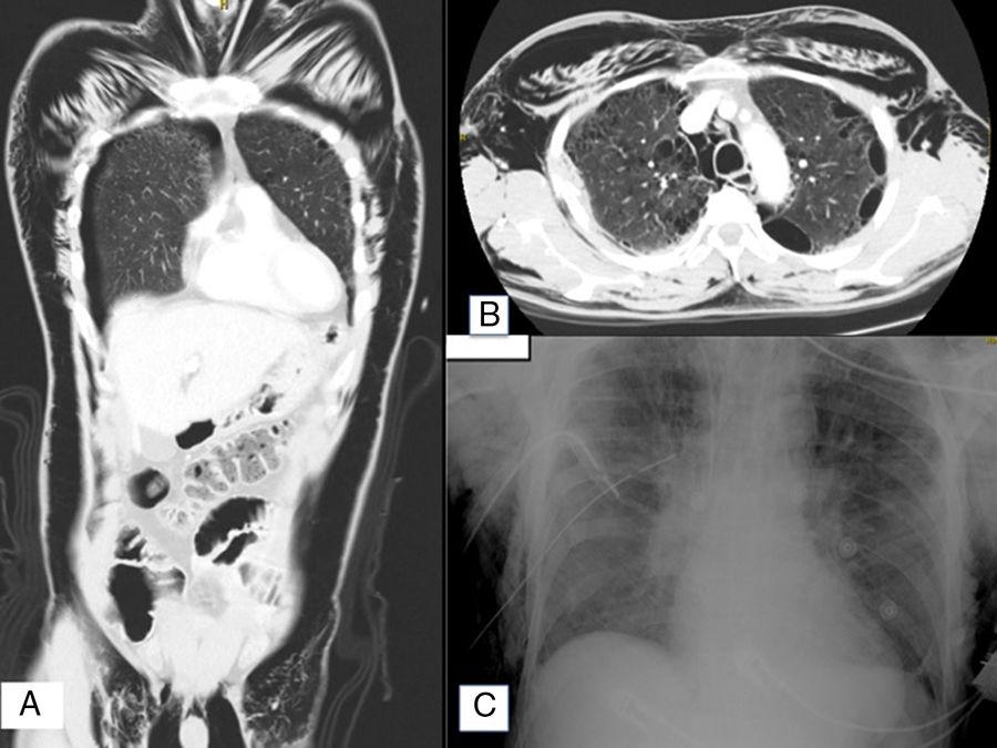 Subcutaneous Emphysema