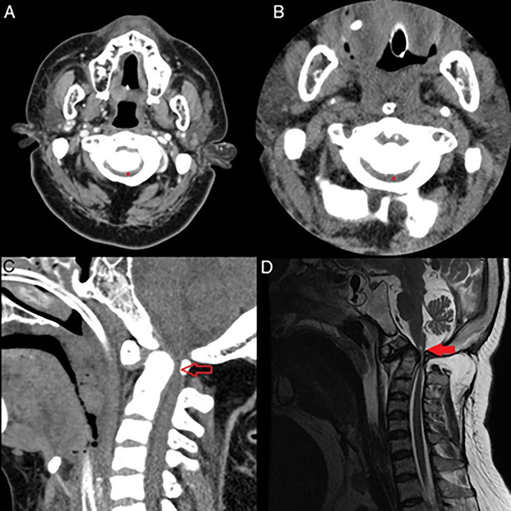 SCIWORA, an injury to know and diagnose | Medicina Intensiva