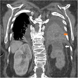 Renobronchial abscess. Sepsis secondary to complicated renoureteral ...