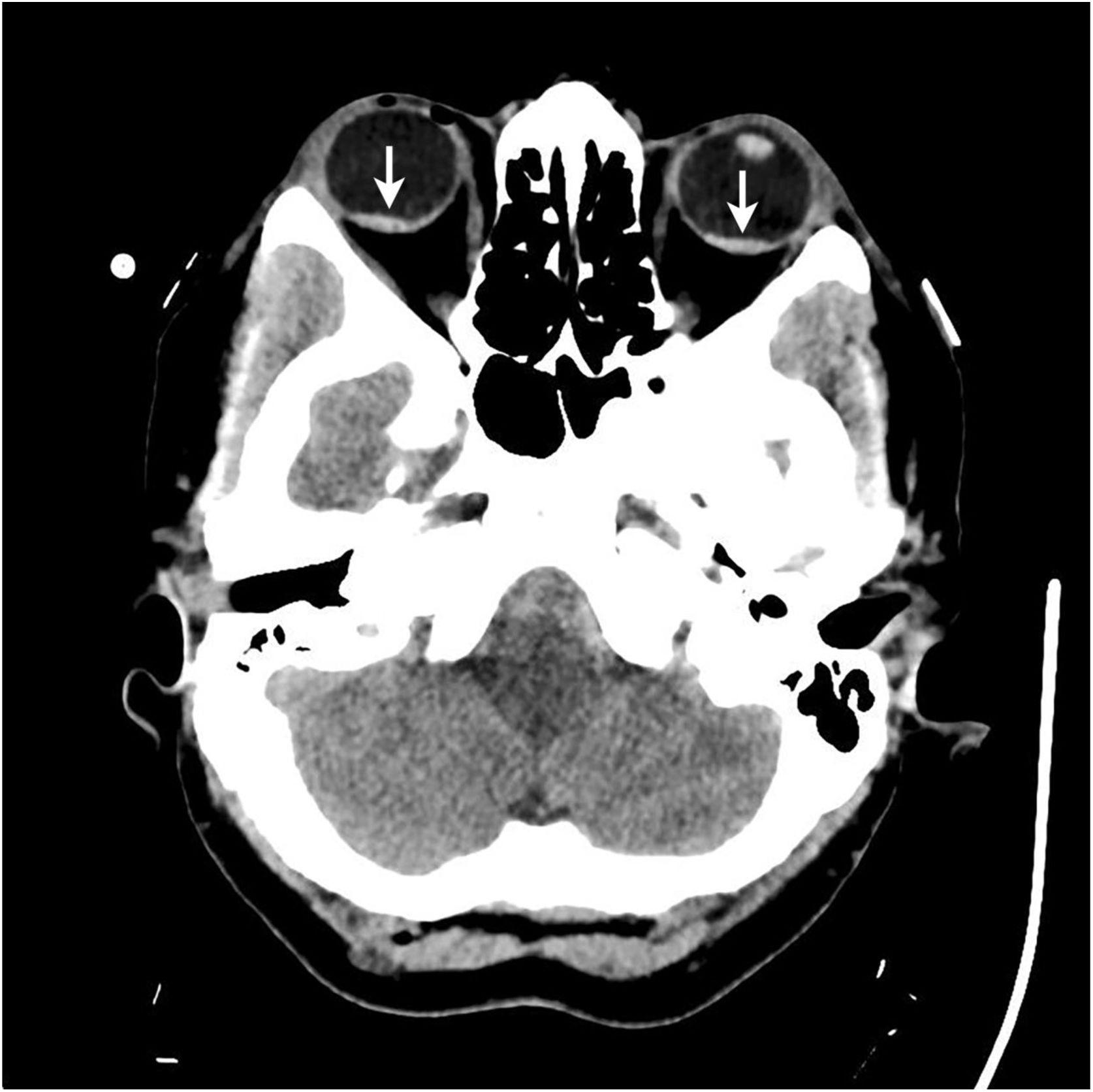 Terson syndrome: A condition to keep in mind | Medicina Intensiva