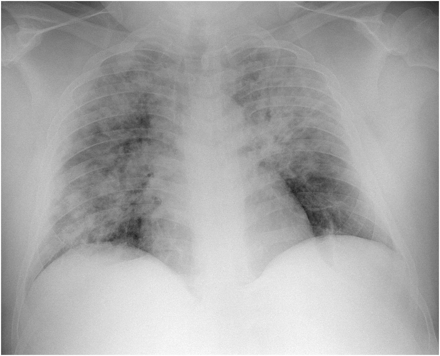 Pnuemonia On A Chest X Ray