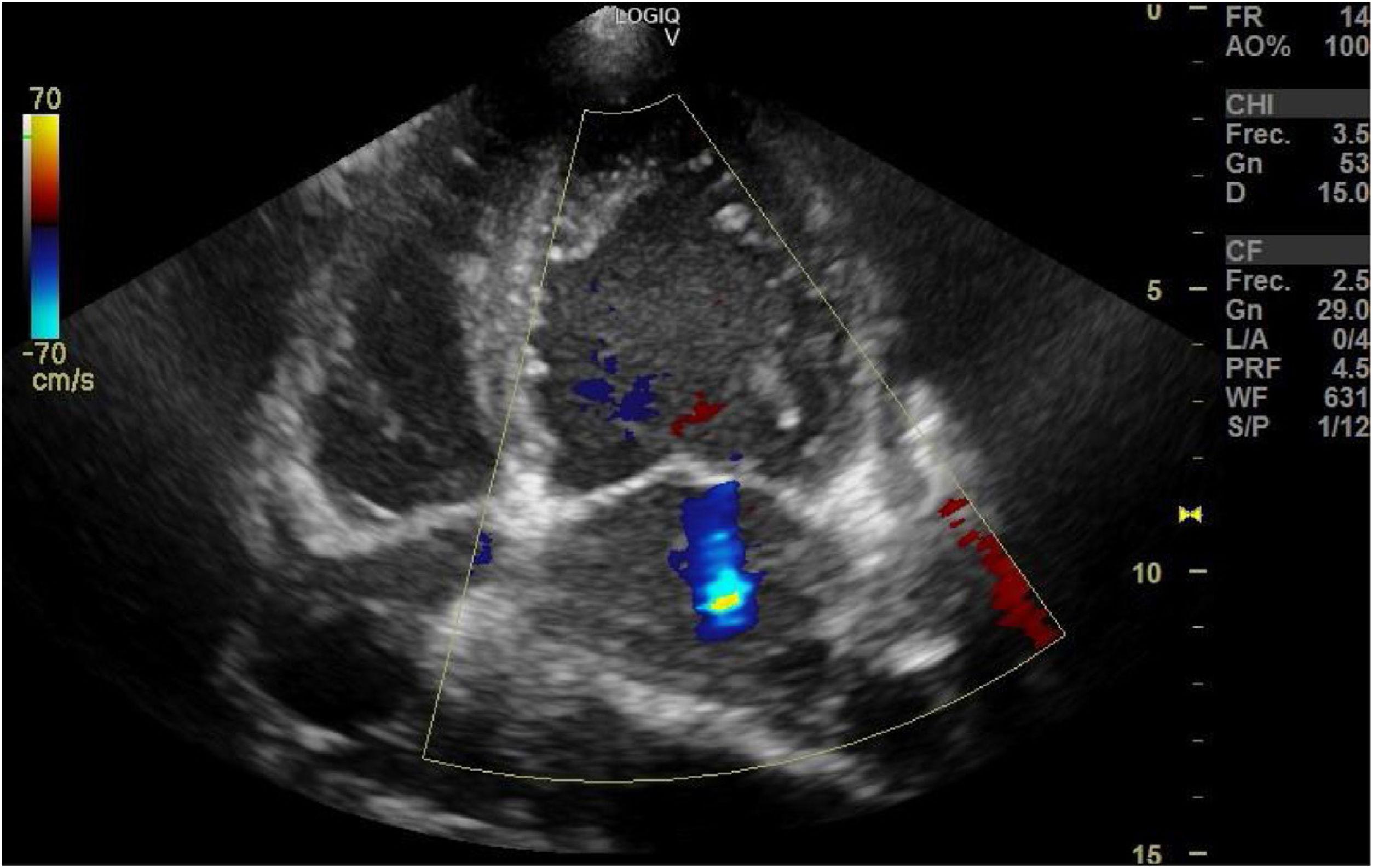 Echocardiography features of non-compaction cardiomyopathy | Medicina ...