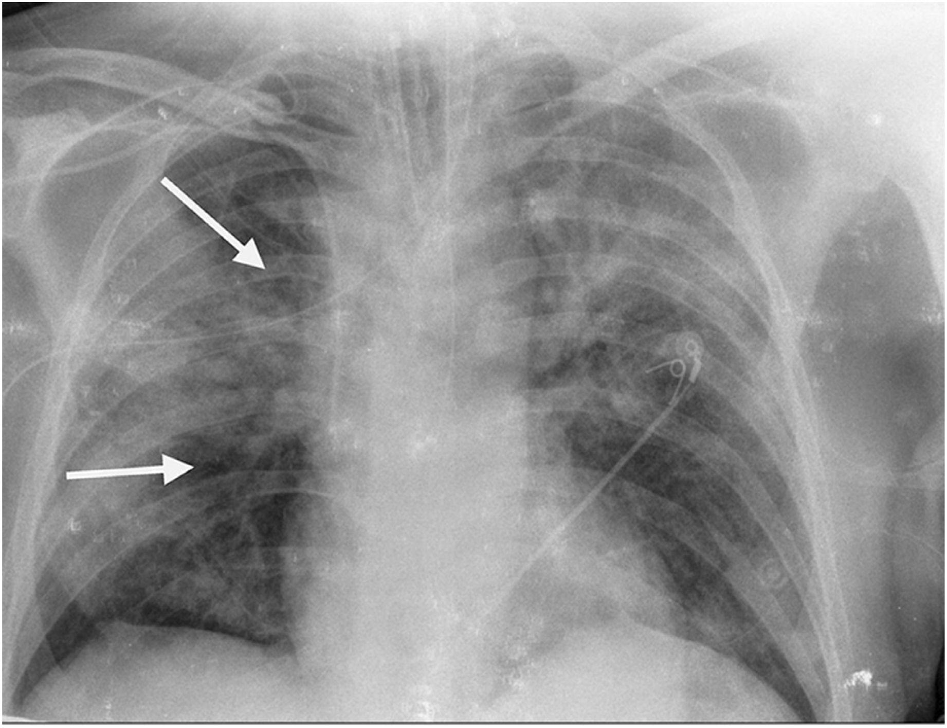 Peripheral pulmonary thromboembolism in COVID-19 bilateral pneumonia ...