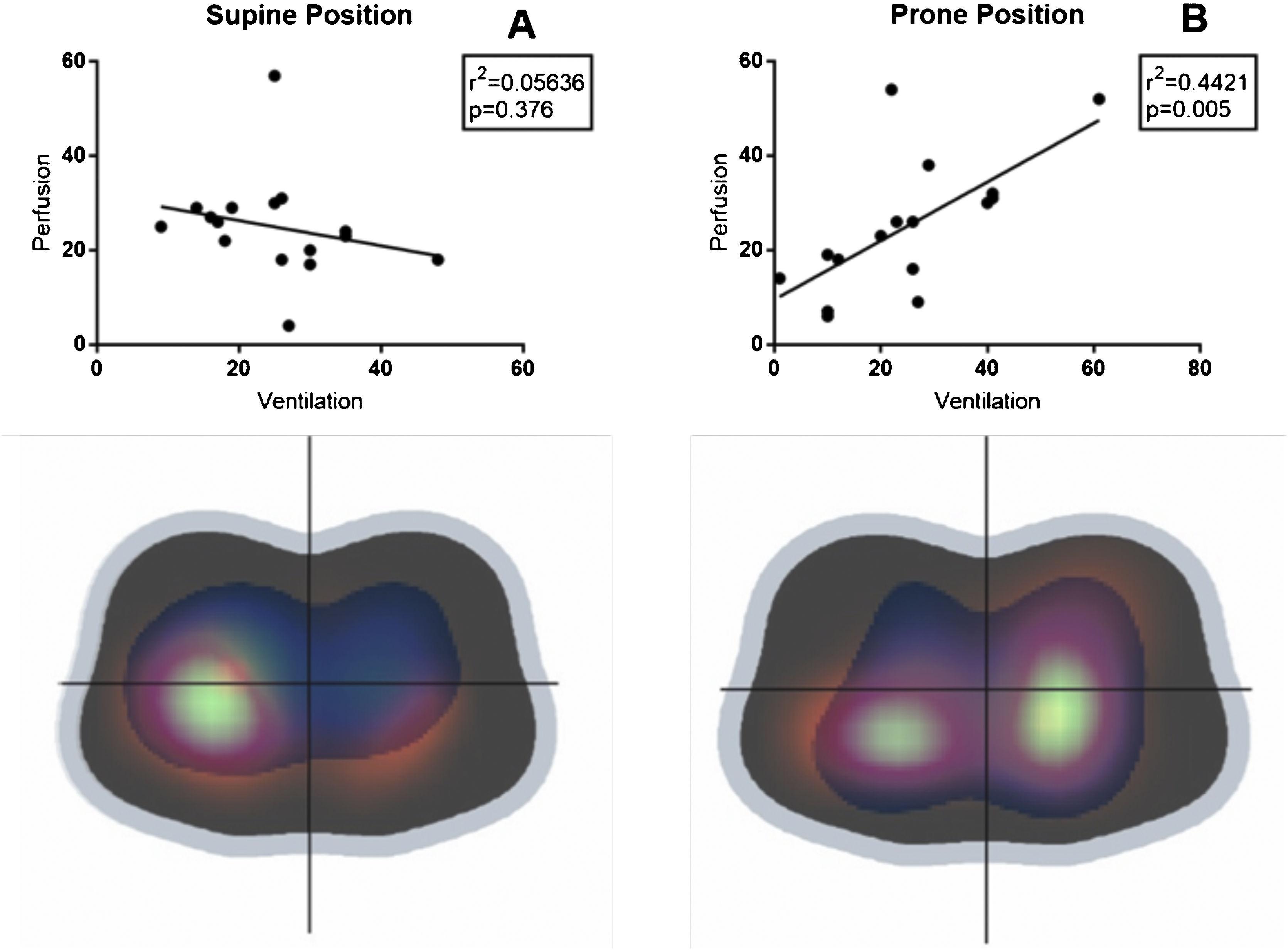 Prone position improves ventilation-perfusion mismatch in patients with ...