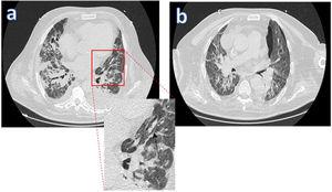 Macklin effect as an early radiological predictor of barotrauma in ARDS ...