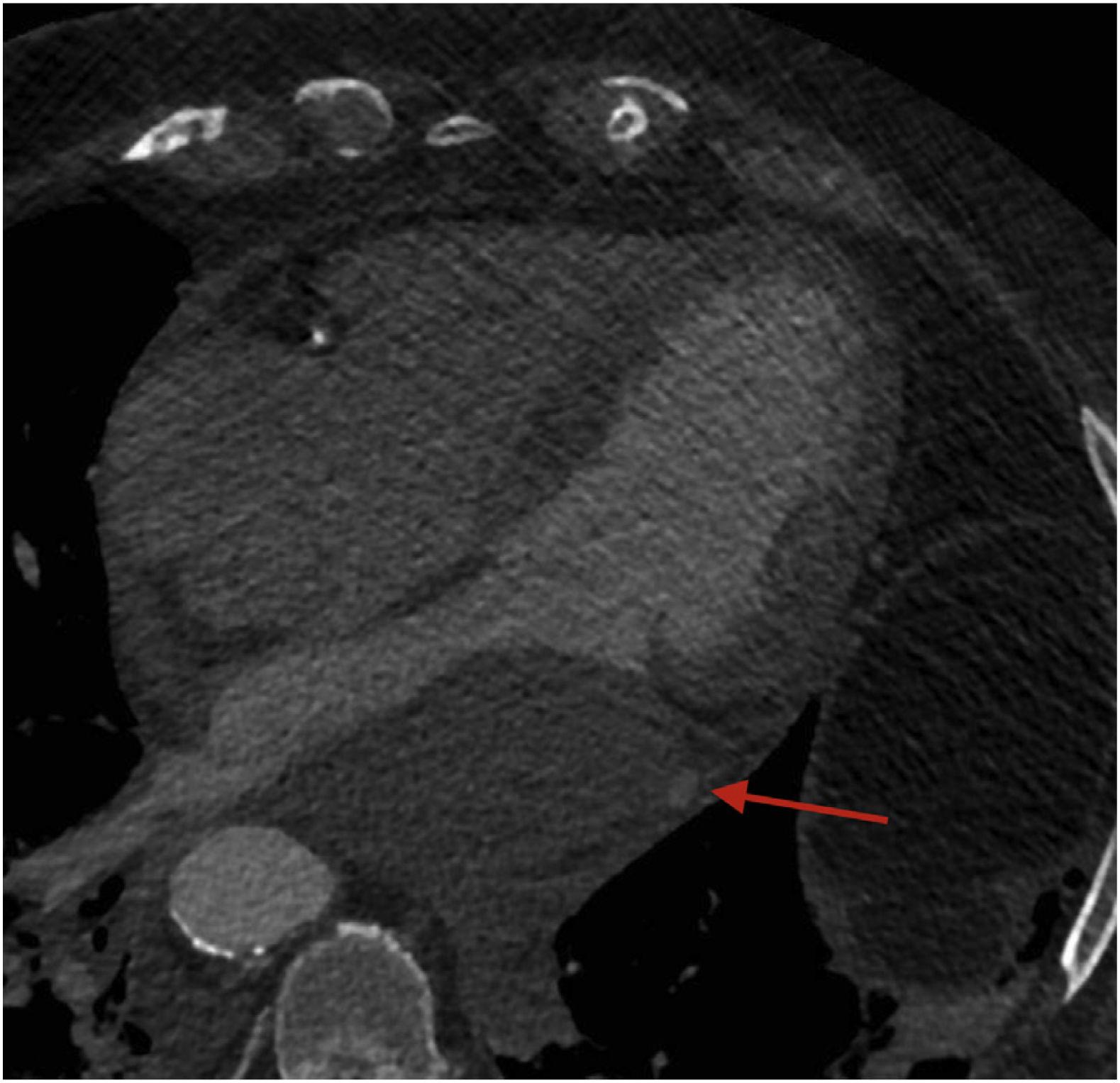 Intramural left atrial hematoma secondary to circumflex coronary artery ...