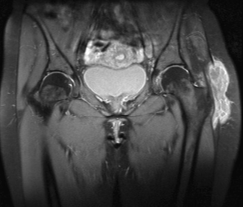 Trochanteric Bursitis Mri