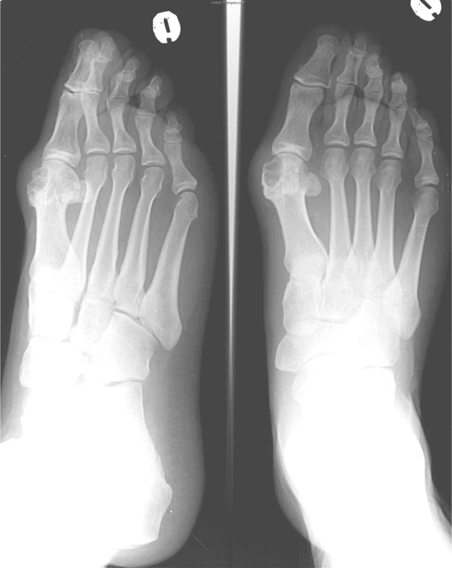 Intrabony Tibial Tophi in Chronic Gout | Reumatología Clínica