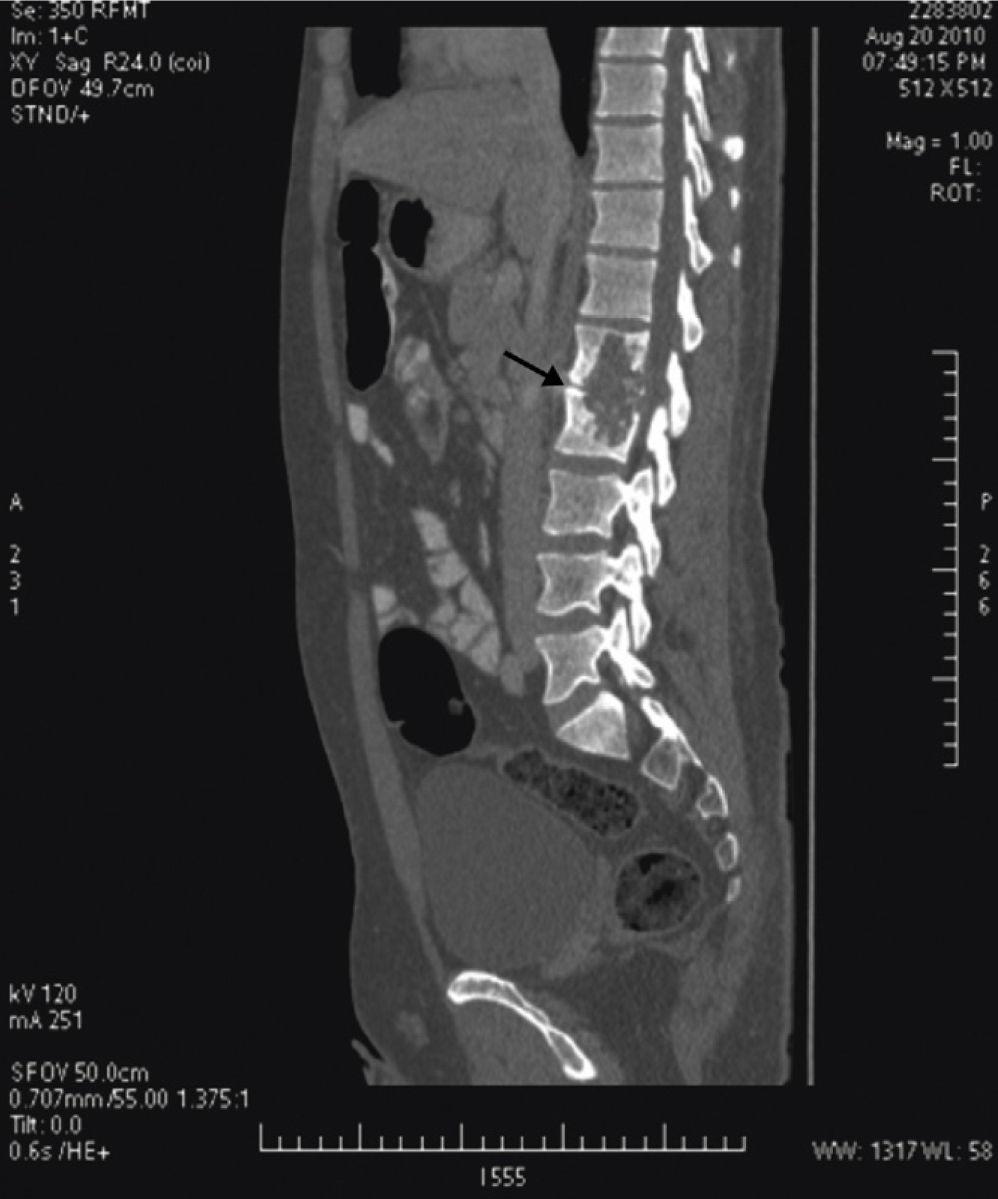 Tuberculous Spondylodiskitis With Lumbar Tumor | Reumatología Clínica