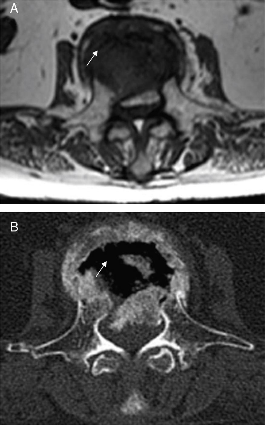 Vertebral Osteonecrosis as a Complication of Steroid Treatment: The ...