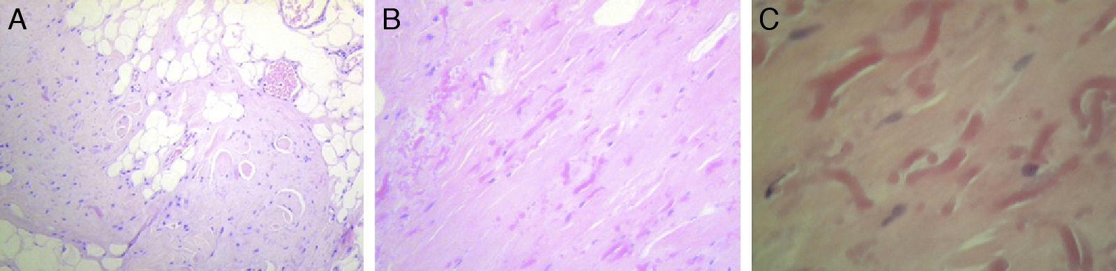Elastofibroma Dorsi: Review of 4 Cases | Reumatología Clínica