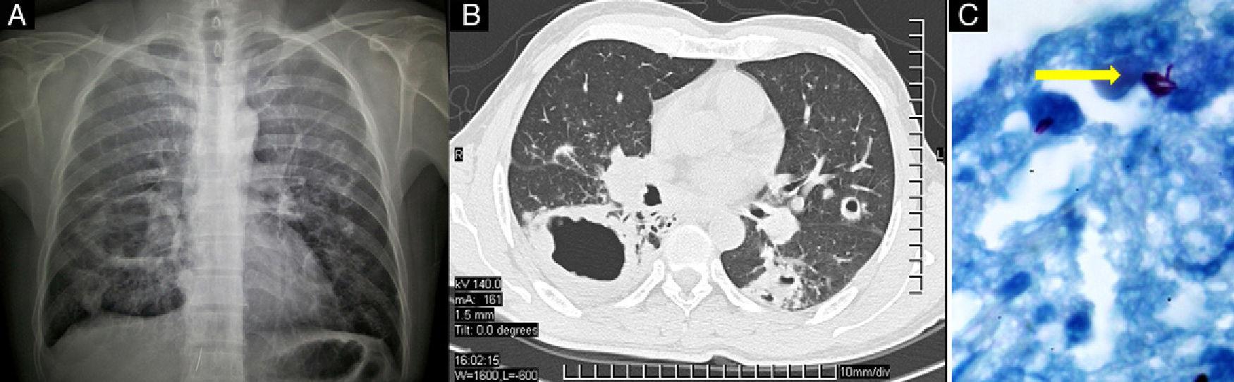 A 44 Year-old-man With Cavitary Pulmonary Disease | Reumatología Clínica