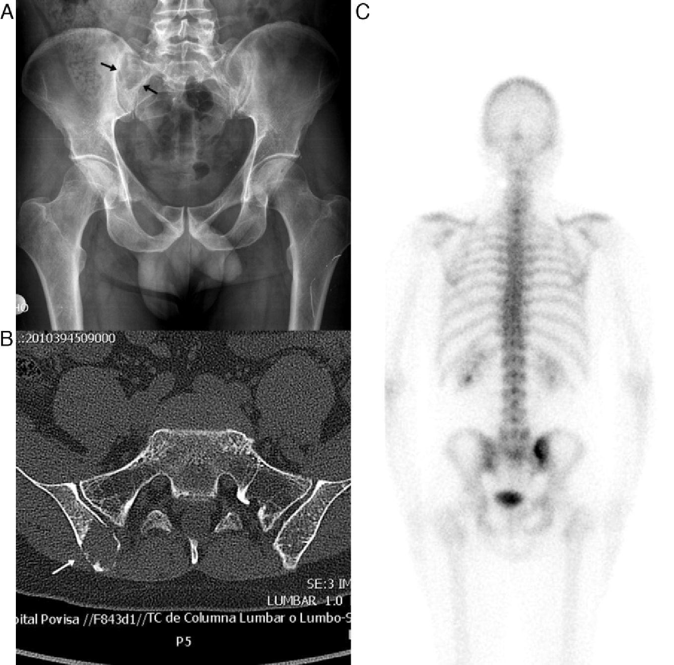 Epithelioid Sarcoma of the Right Ilium Mimicking Sacroiliitis ...