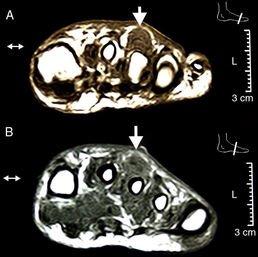 Infectious Tenosynovitis of the Foot Extensors | Reumatología Clínica