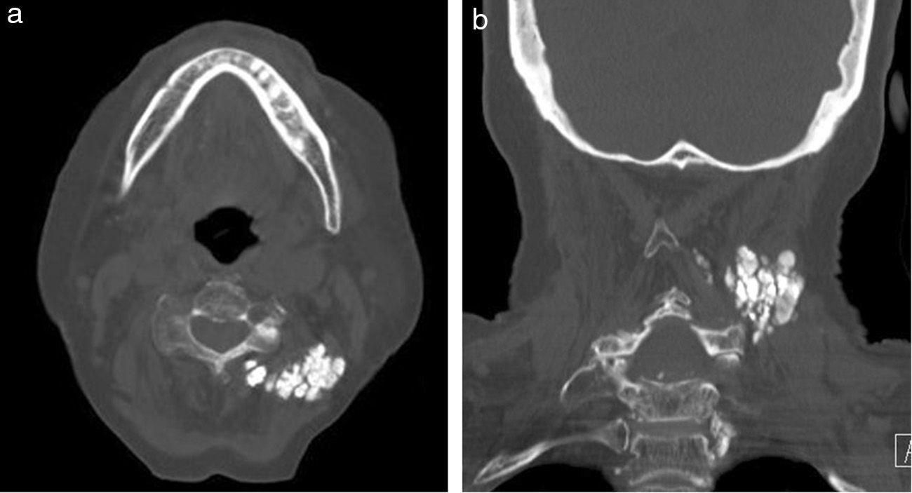 Hard Paracervical Tumor in a Patient With Limited Systemic Sclerosis ...