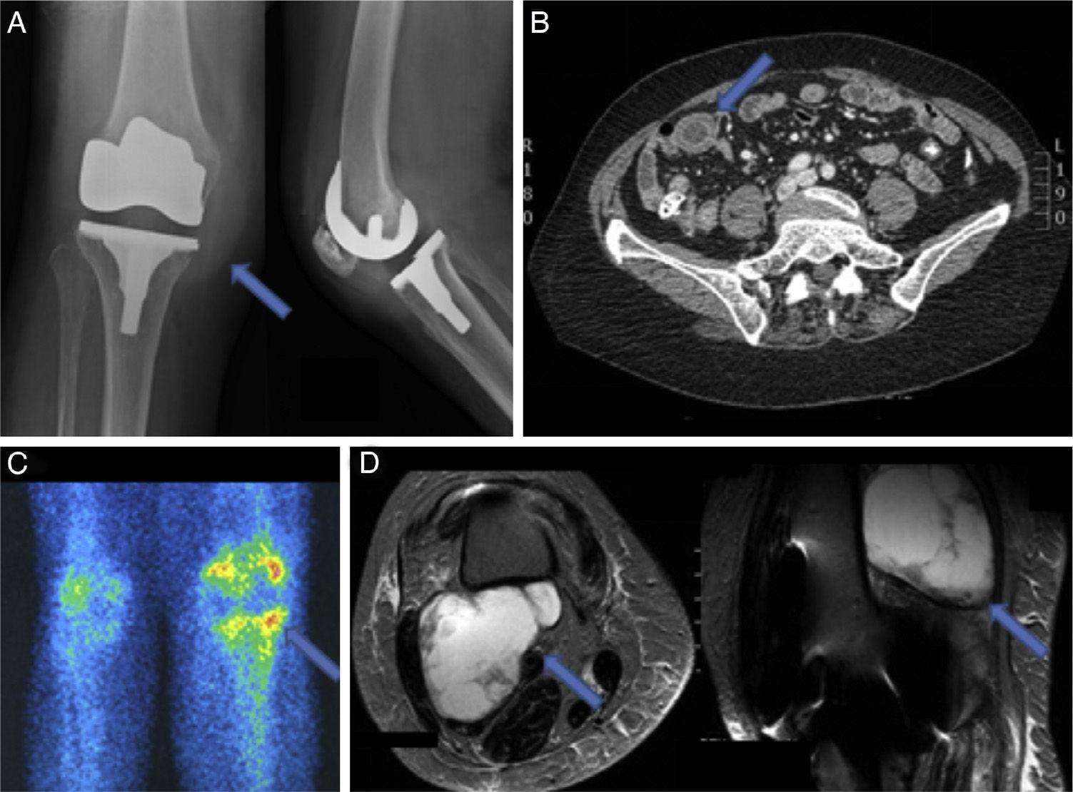 Prosthesis Infection by Mycobacterium tuberculosis in a Patient With ...