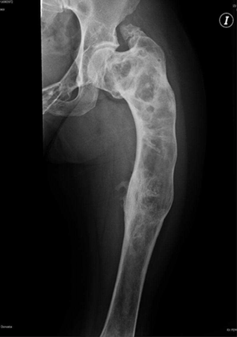 Polyostotic Fibrous Dysplasia Of Bone