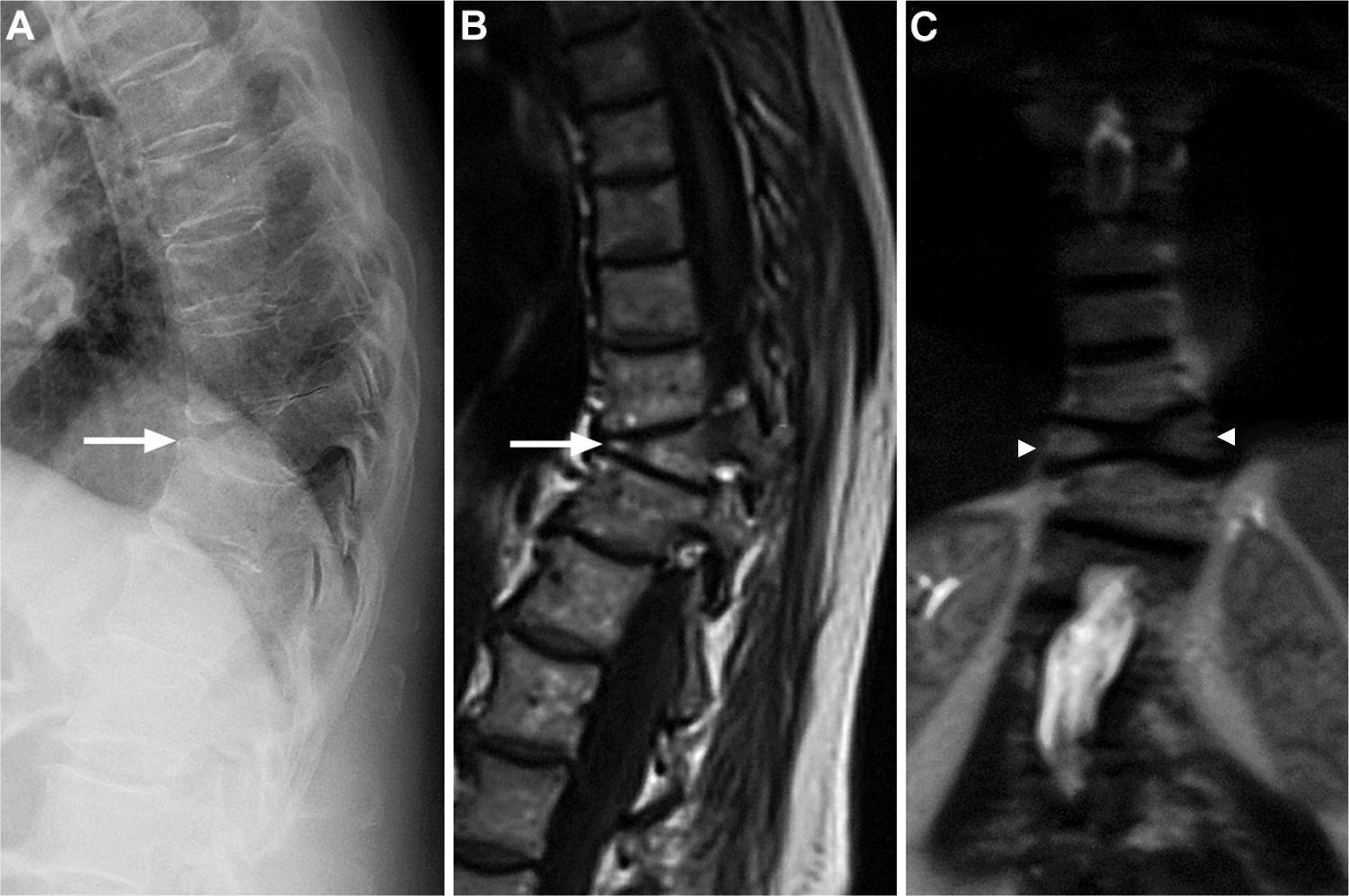 Butterfly Vertebra | Reumatología Clínica