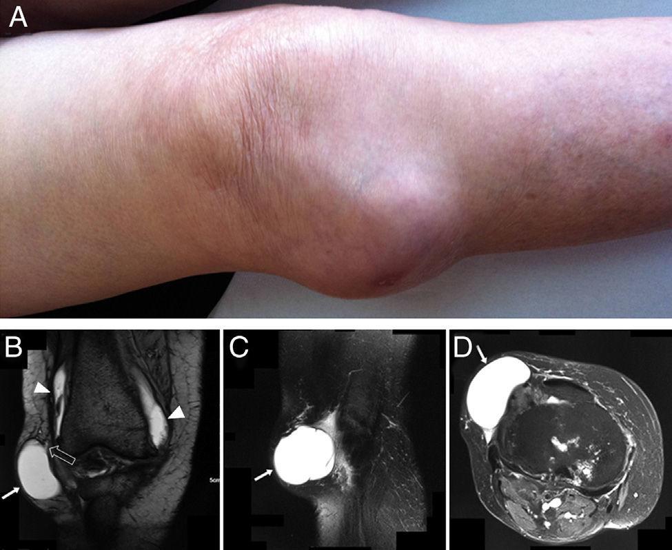 Complicated Parameniscal Giant Cyst With Distal Dissection and Regional ...