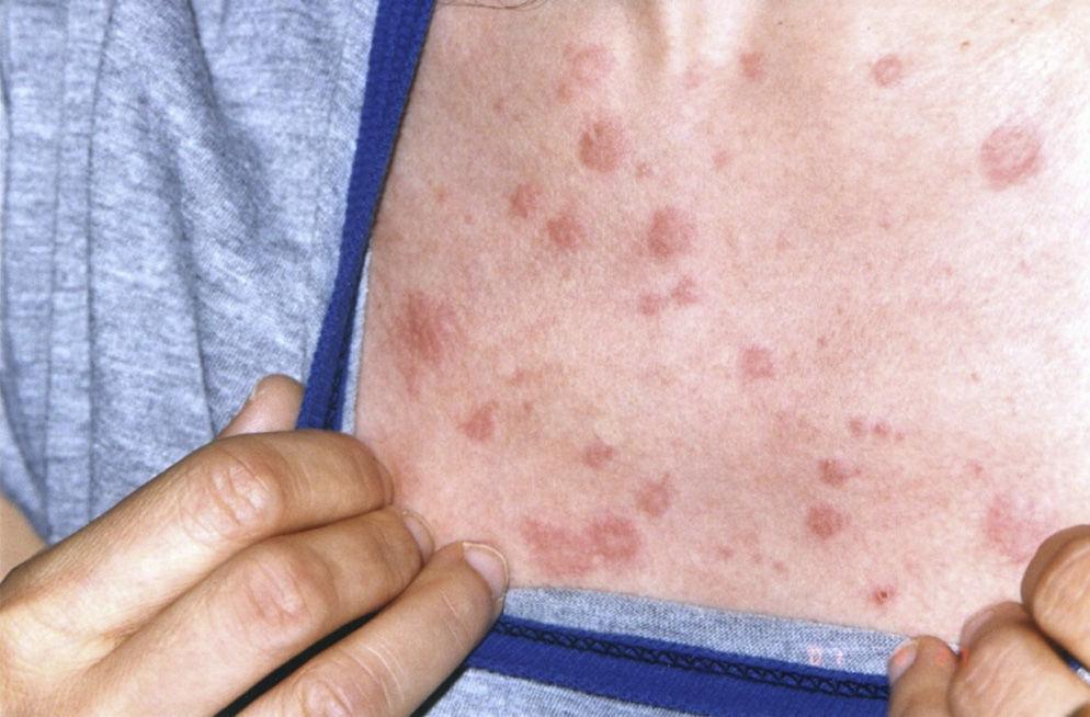 Schnitzler Syndrome | Reumatología Clínica