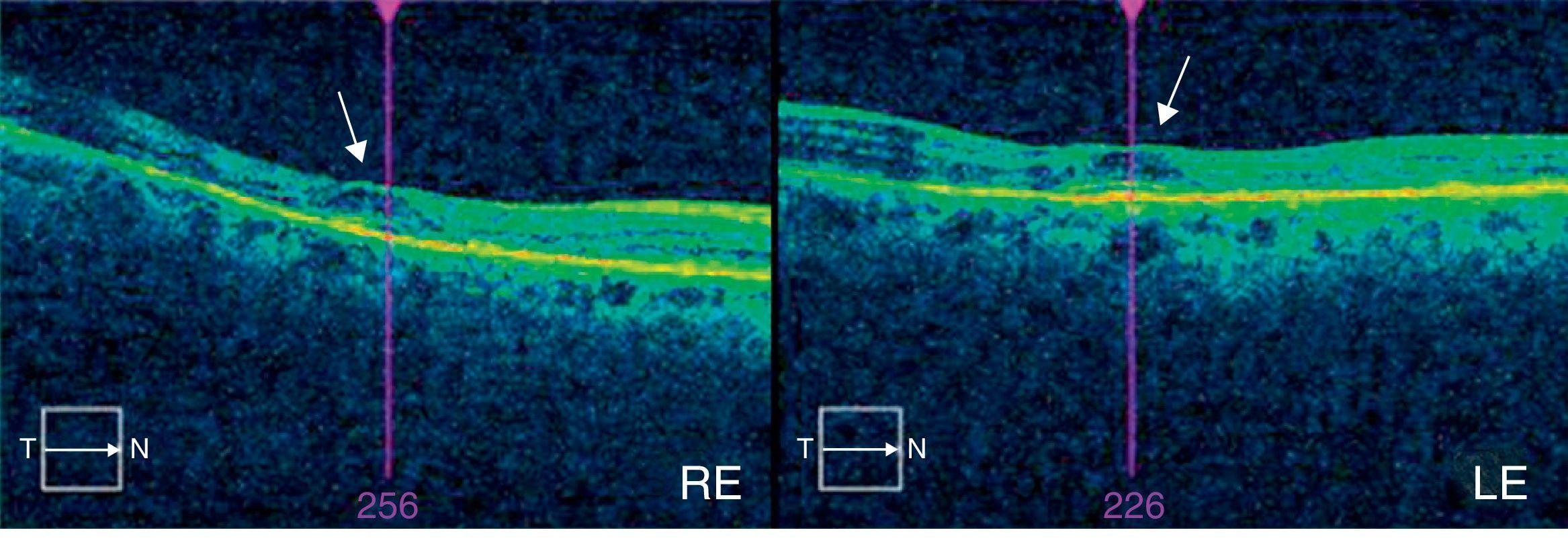 Ocular Toxicity and Functional Vision Recovery in A patient Treated ...