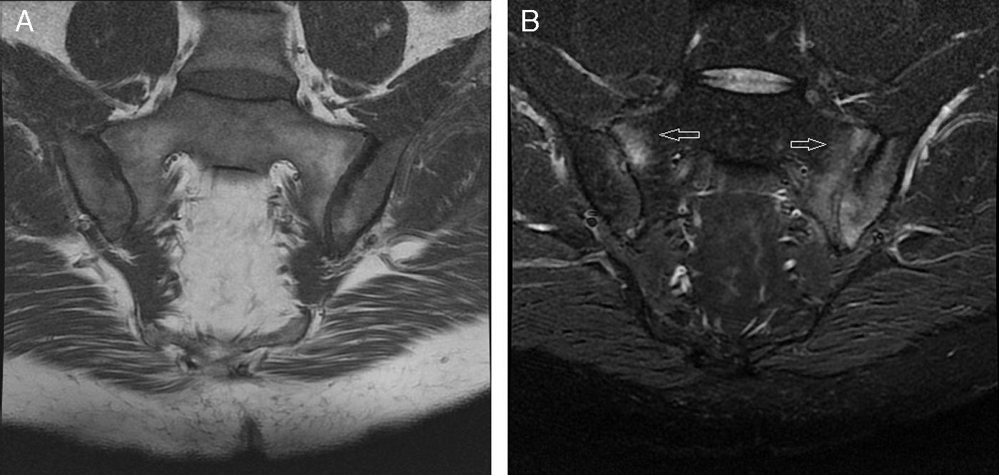 Inflammatory Back Pain in a 44 Year Old Male | Reumatología Clínica