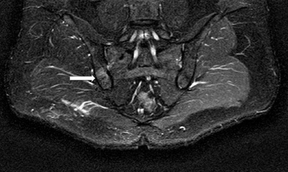 Osteoid Osteoma Spine Mri