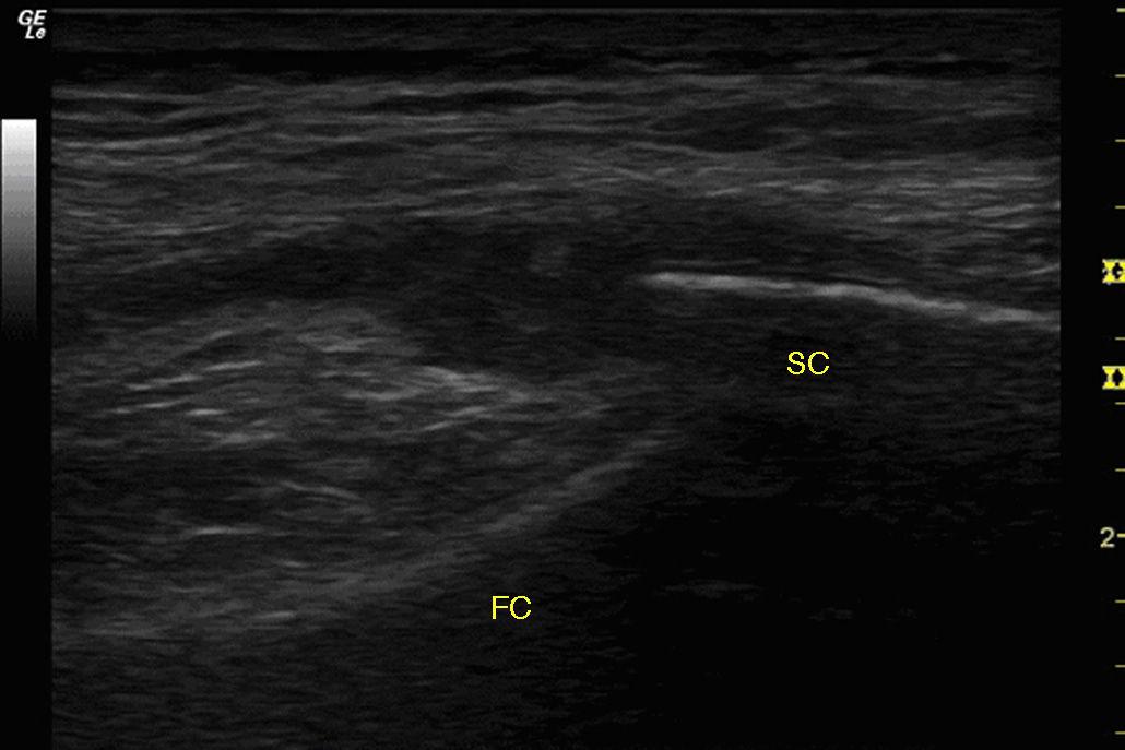 Septic Arthritis by Streptococcus equi | Reumatología Clínica