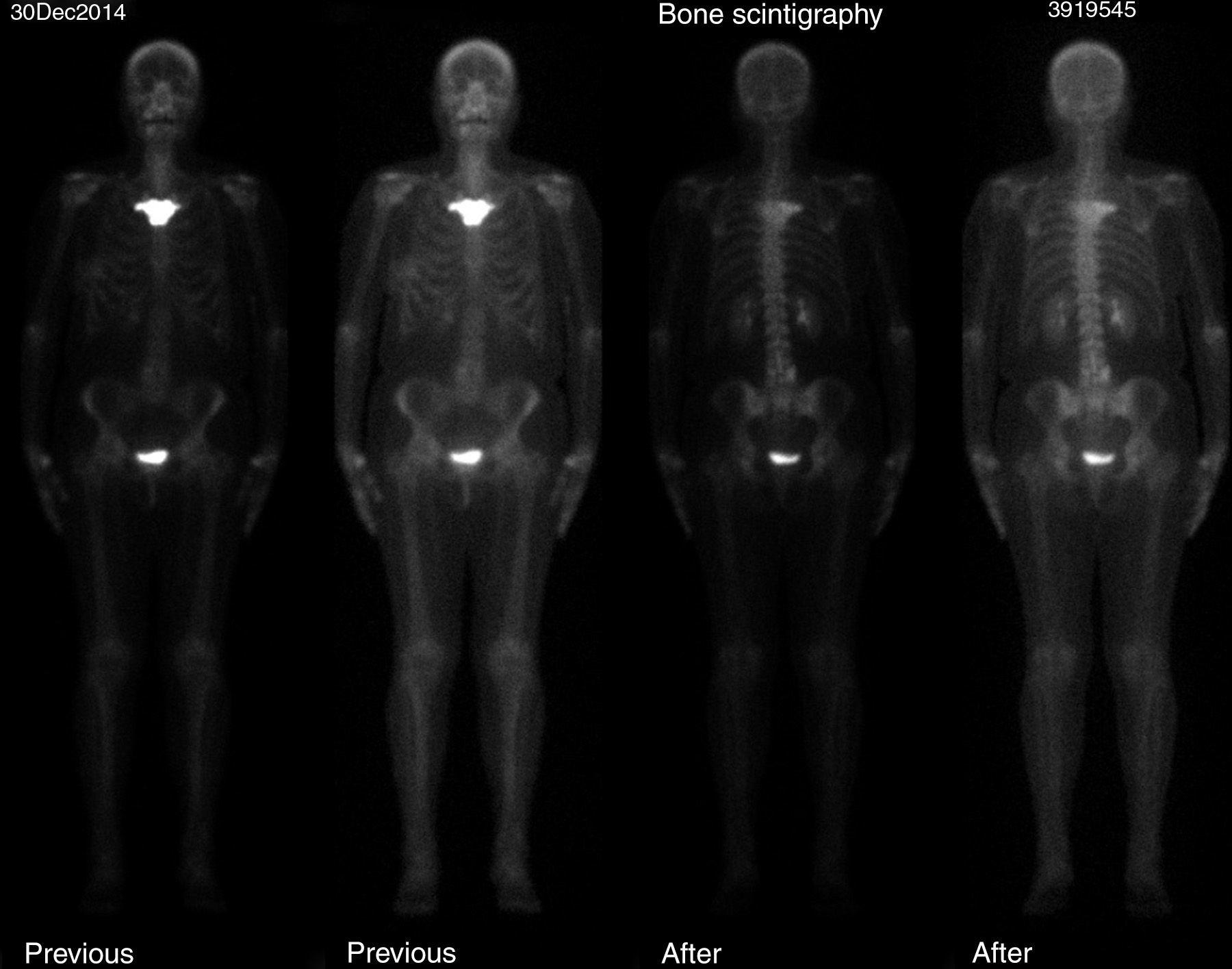 SAPHO Syndrome in the Differential Diagnosis of Metastasis ...